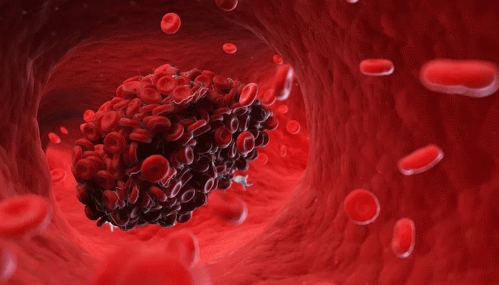 First Time see recurrent blood clots in Arms of a coronavirus patient