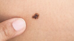 Meaning Of Mole On Private Part Of Female News in Marathi, Meaning Of ...
