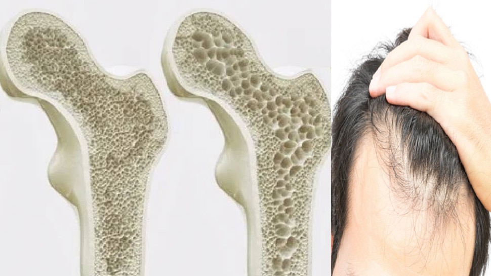 this vitamin deficiency in body cause bone weakness and hair loss know ...