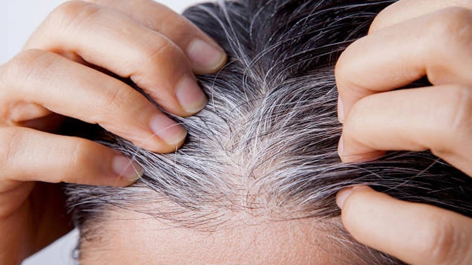 Hair Turned white at a young age know Solution