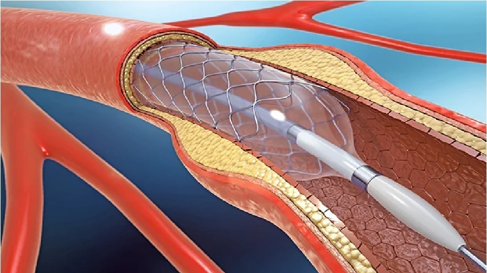 The Union Health Ministry has announced the decision to include stents ...