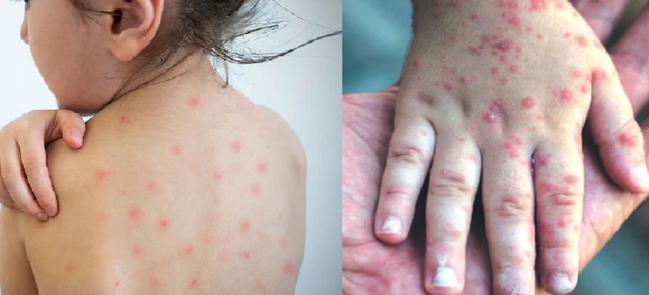 Measles Update : Outbreak of Measles in Maharashtra GS