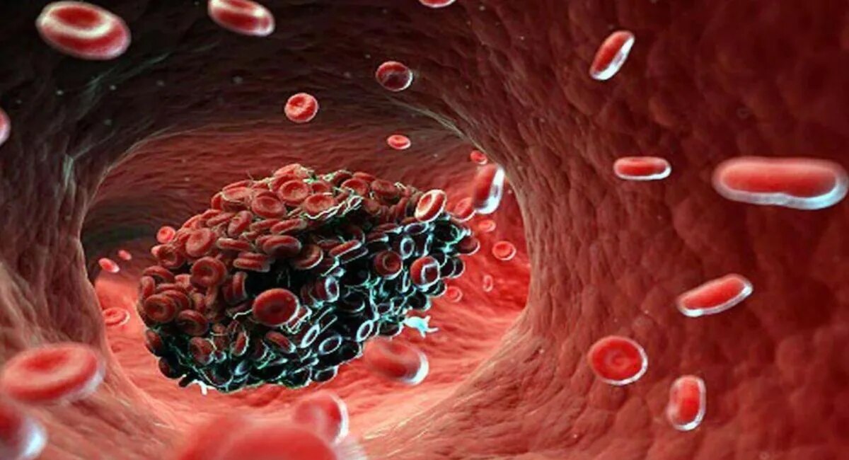 Blood Clot Signs Symptoms These symptoms seen when blood clot is formed ...