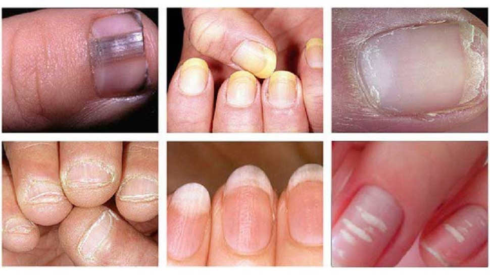 Health News your nail color wwill tell you about your bad health do ...