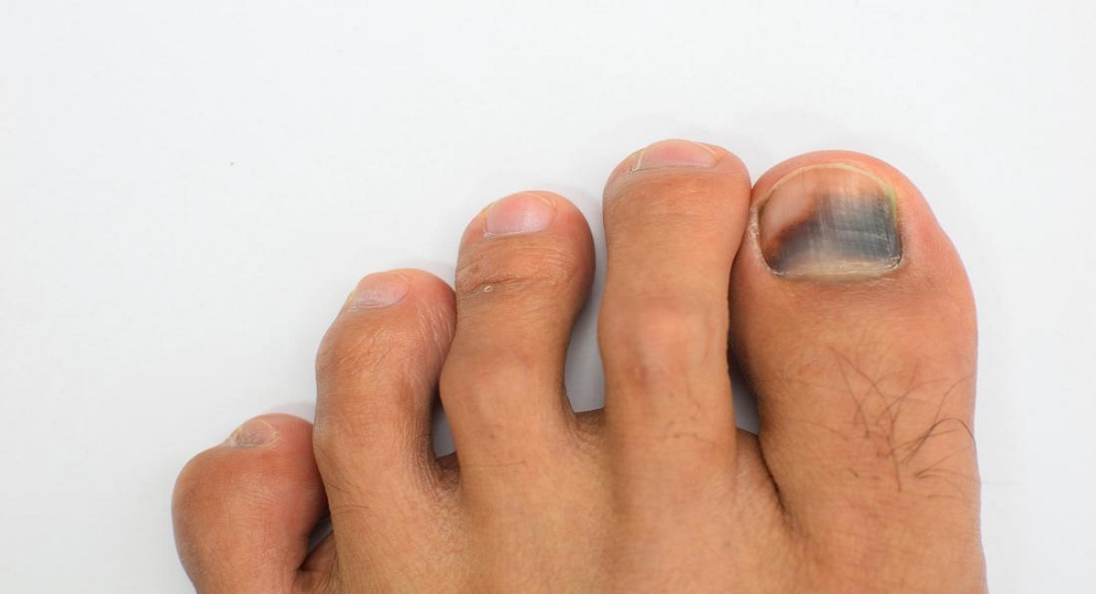 Black toe nail know the reason and remedies at home lifestyle hacks ...