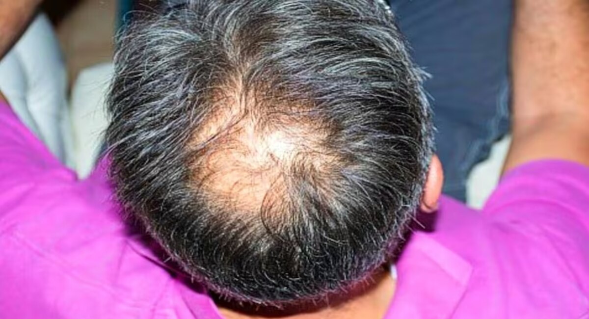 home remedies to regrow hair on bald patches tlifn know details in marathi