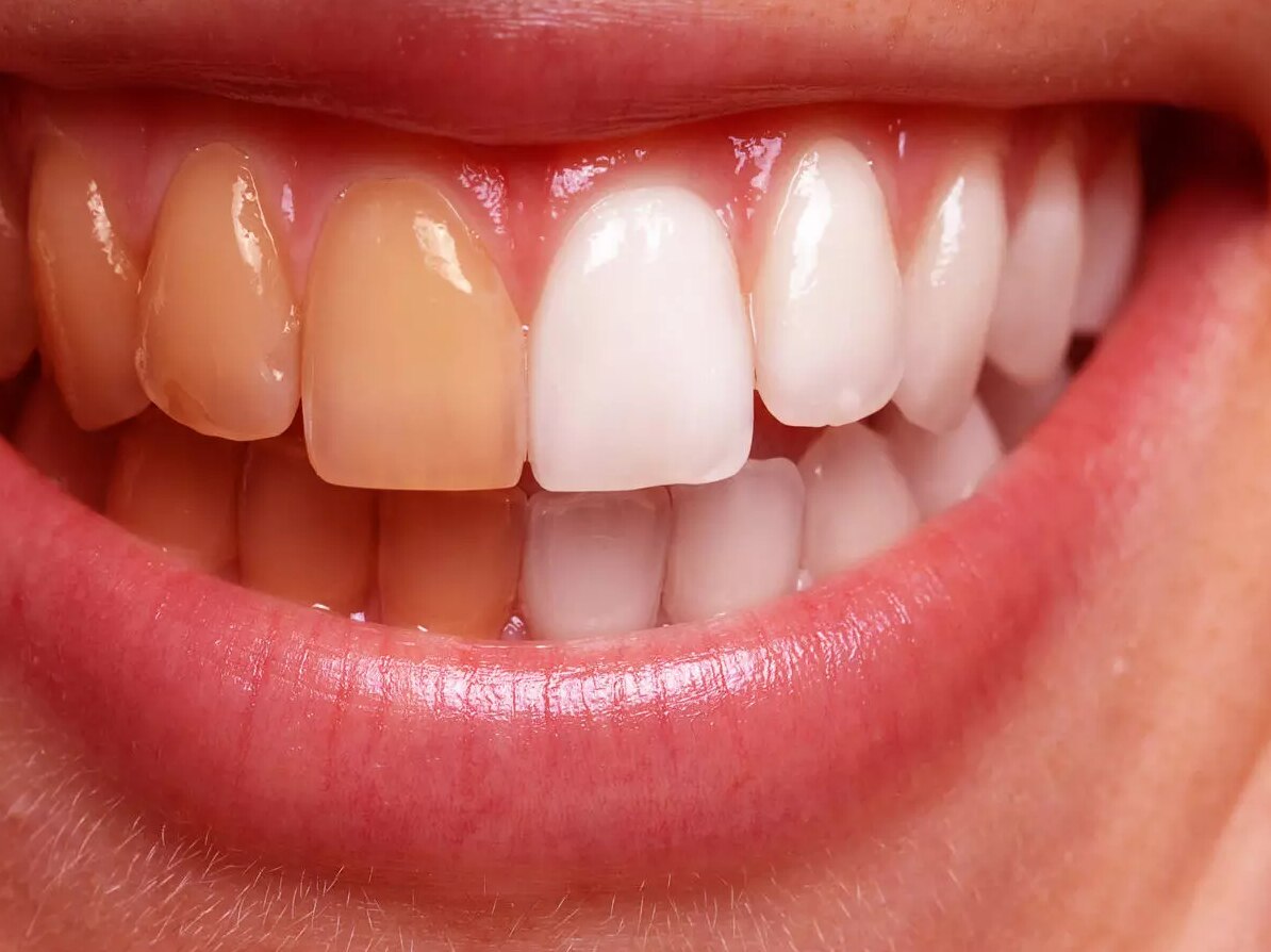 This homemade paste will make your teeth shine like pearls