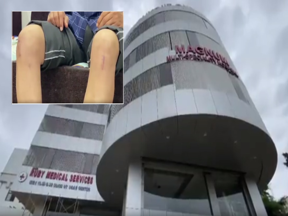 Nashik Crime news doctor amputated the wrong leg while removing the rod