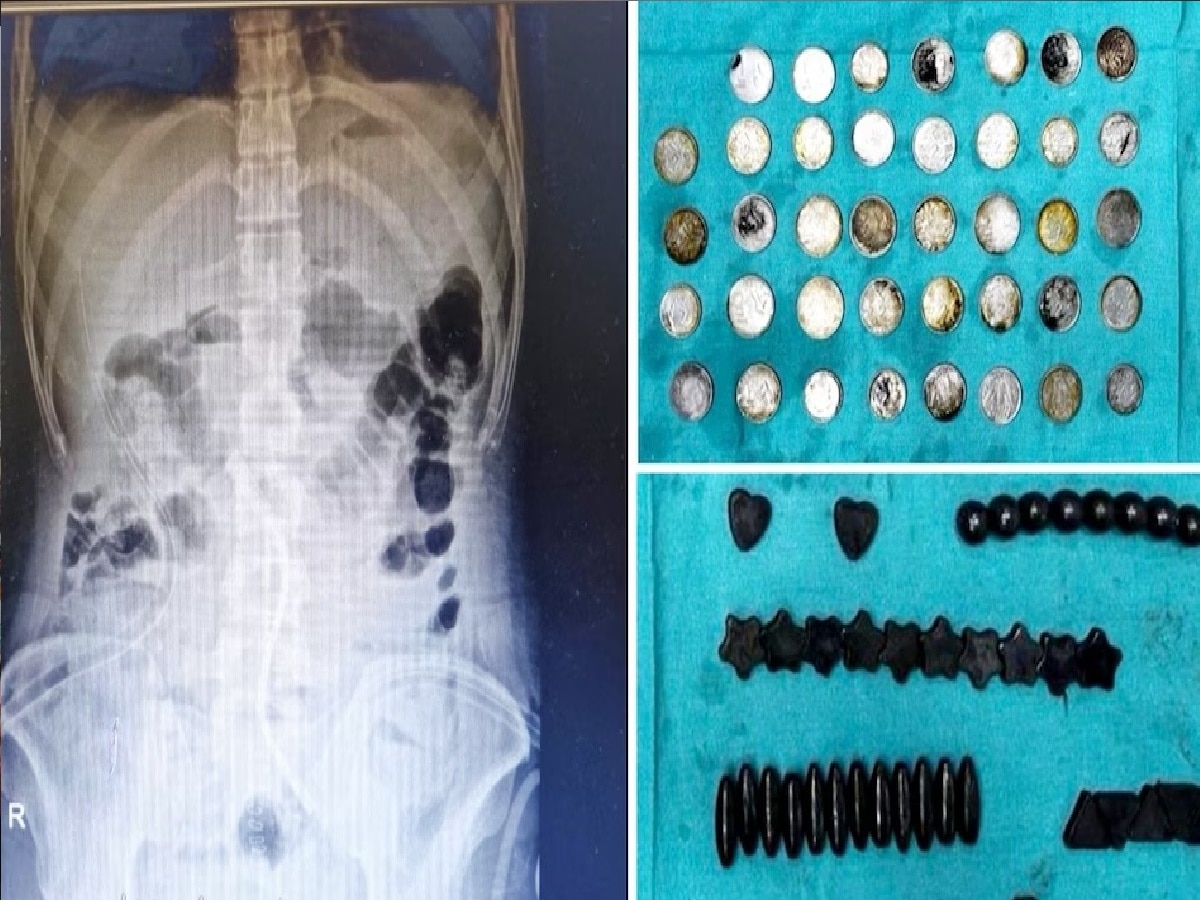 viral news young boy swallowed coins and magnets to build th zinc in ...