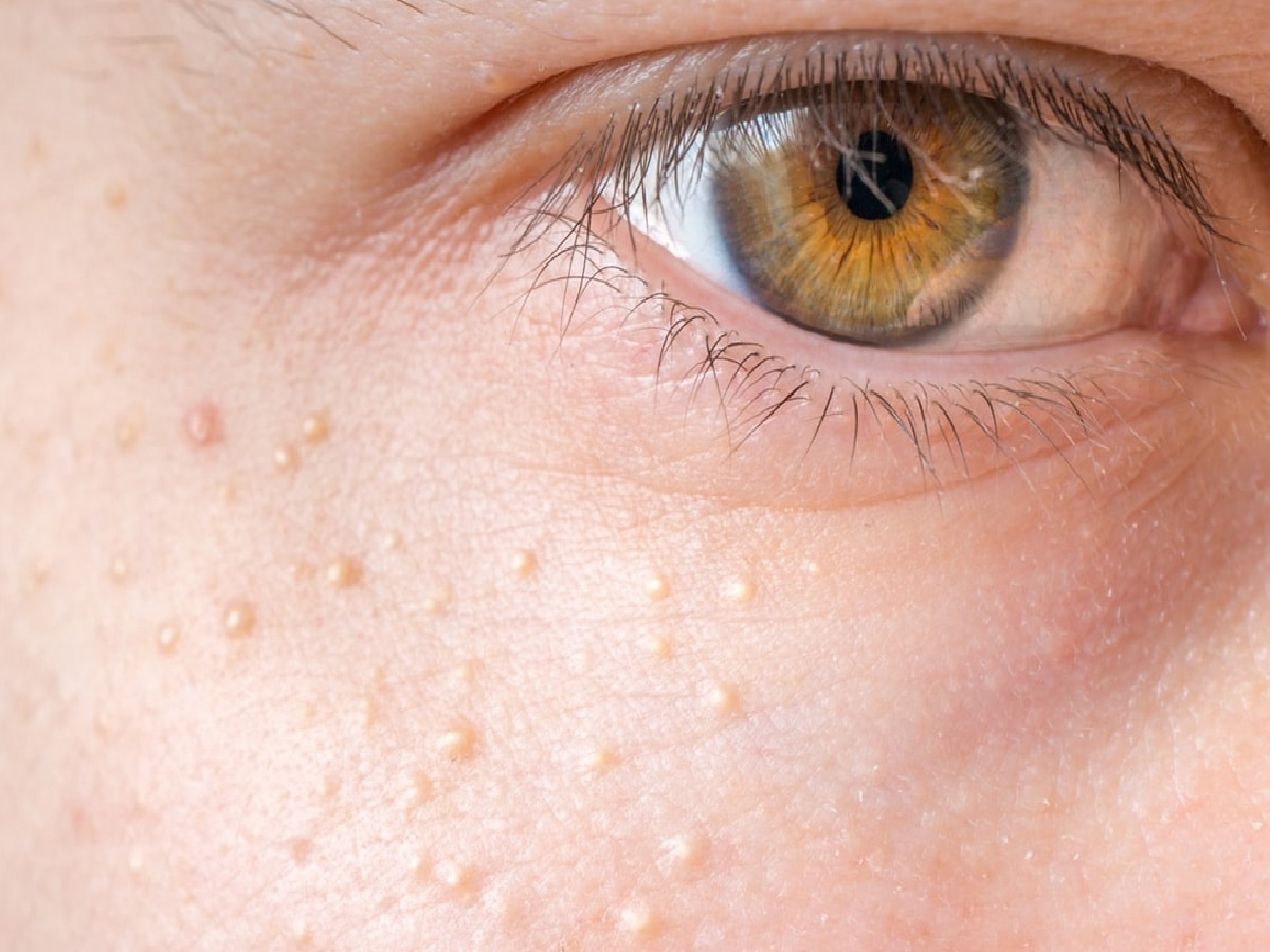 PHOTO: कोलेस्ट्रॉल वाढल्यास तुमच्या चेहऱ्यावर दिसतात 'हे' बदल; पाहा ...