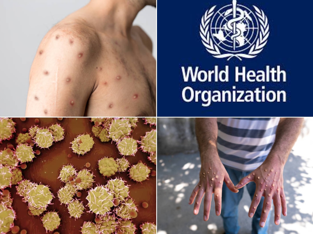 WHO declares mpox a global public health emergency Know A to Z about ...
