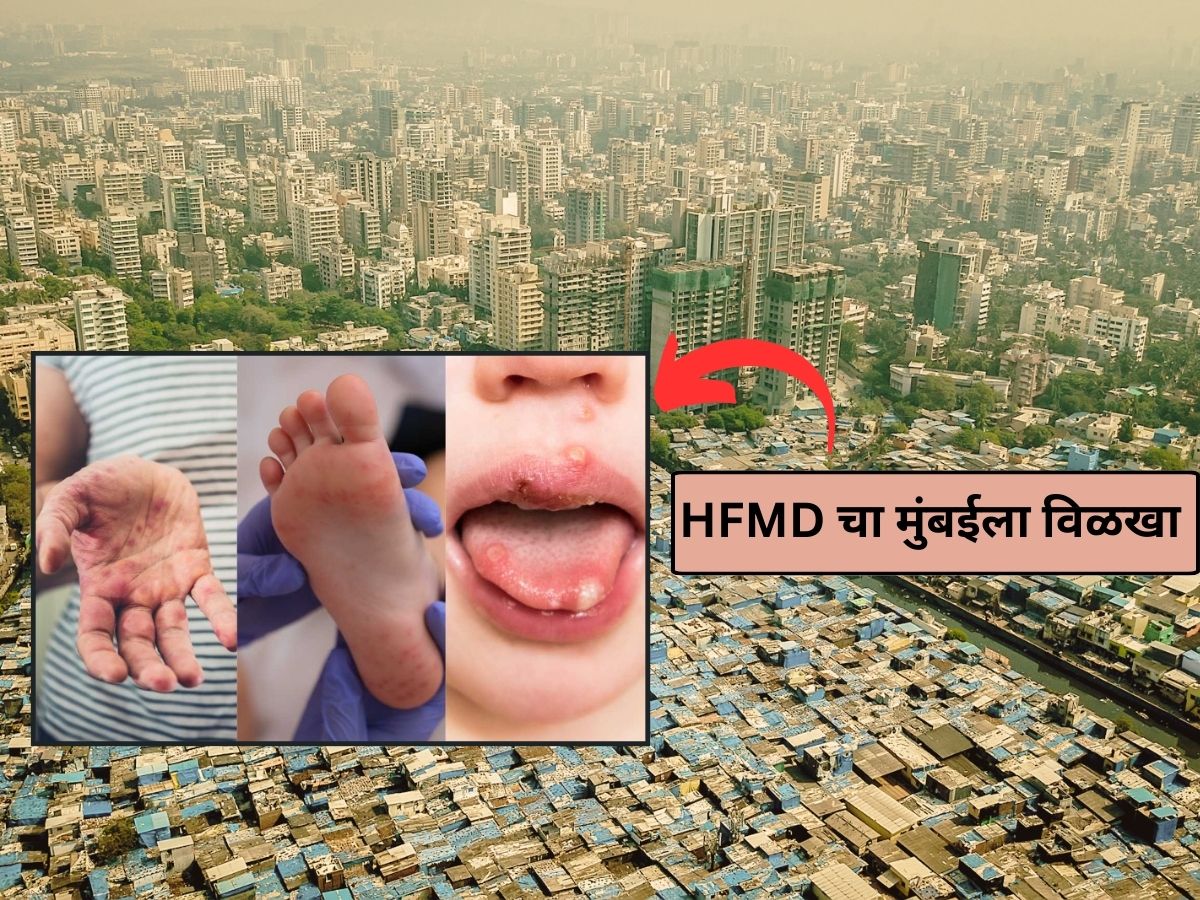 Risk of HFMD to children in Mumbai know symptoms and Treatment; लहान ...