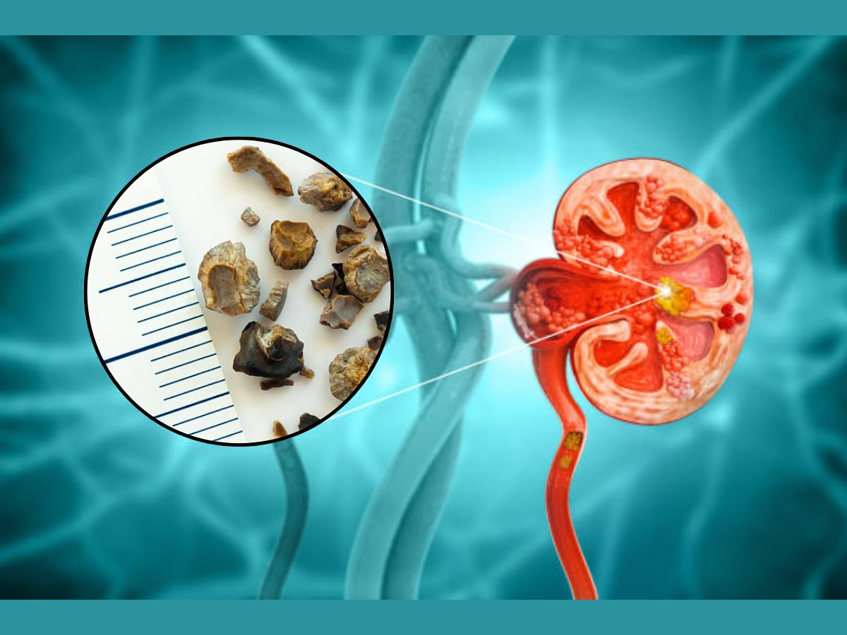 Kidney Stone Paitents Avoid 6 fruits very harmful for Pathari or ...