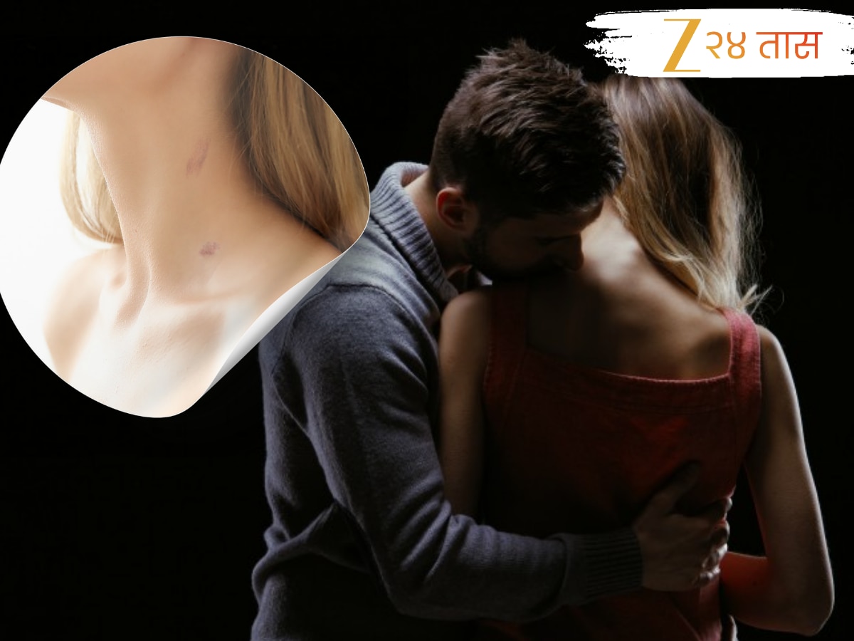 'love Bite' मुळे स्ट्रोकचा धोका! Hickey संदर्भात डॉक्टरांचा गंभीर इशारा | Love Bite can cause ...