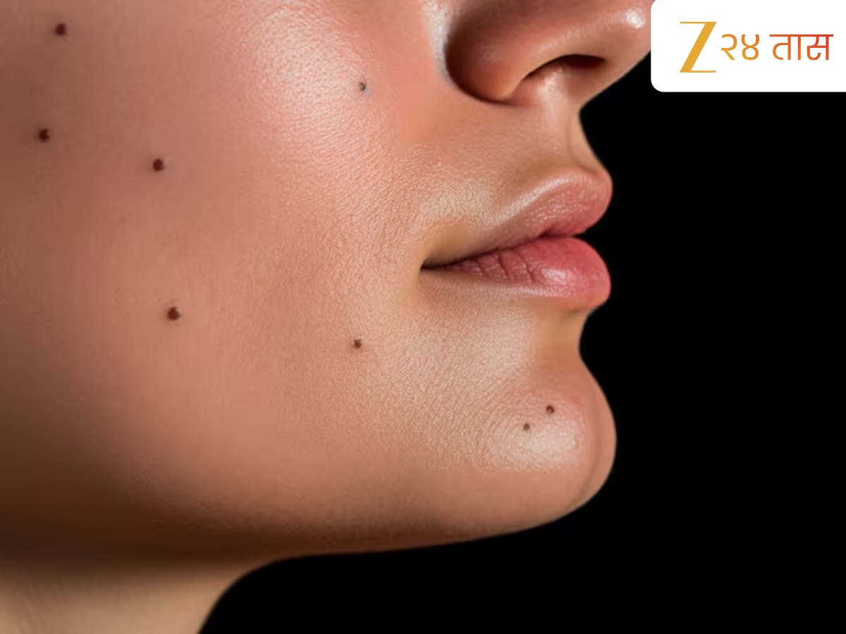 Samudrik Shastra: Meaning of Mole on Cheeks Is It Auspicious or ...