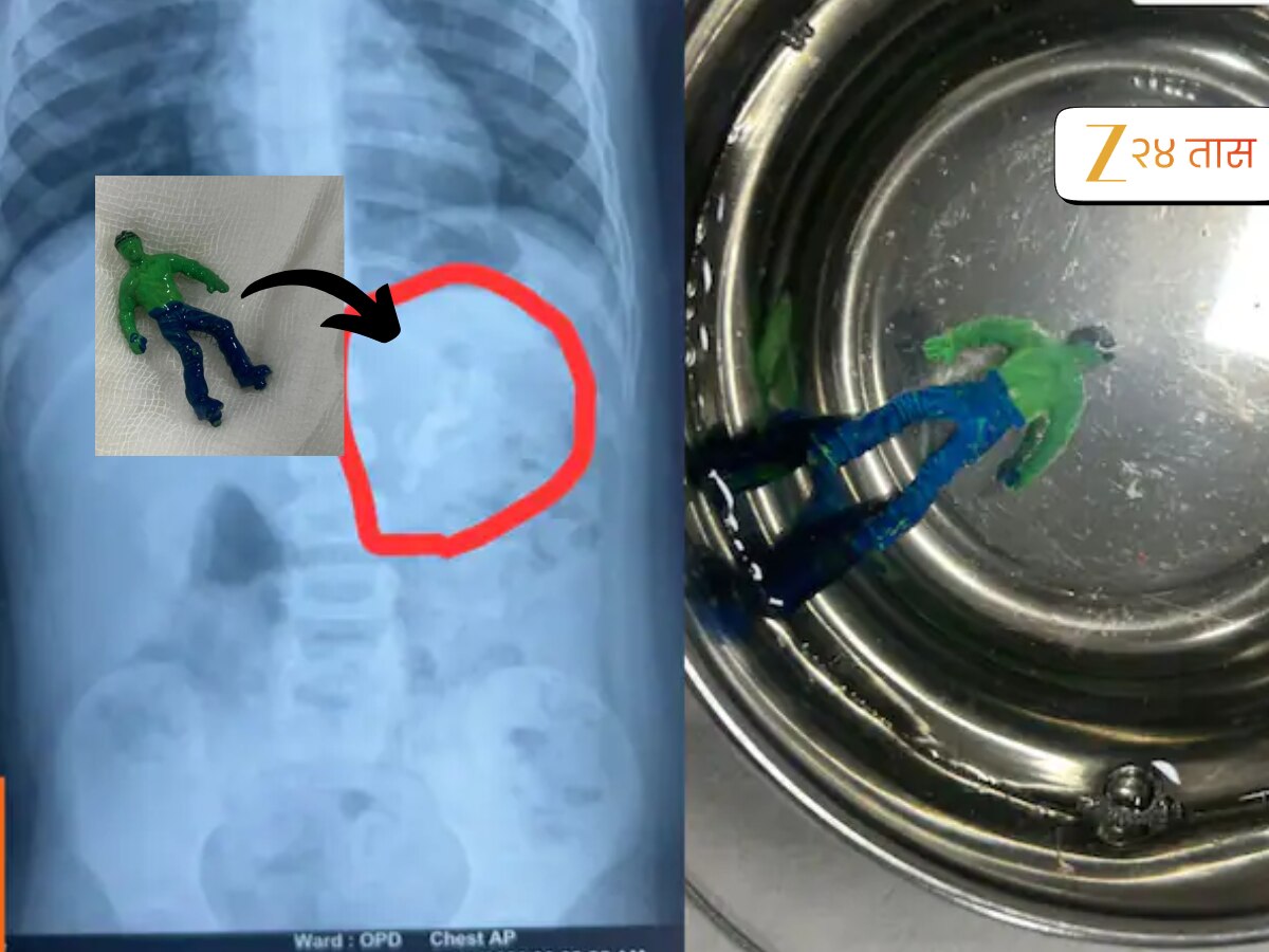 Ahmedabad Toddler Swallows The Hulk Shocking X Ray Leaves Doctors ...